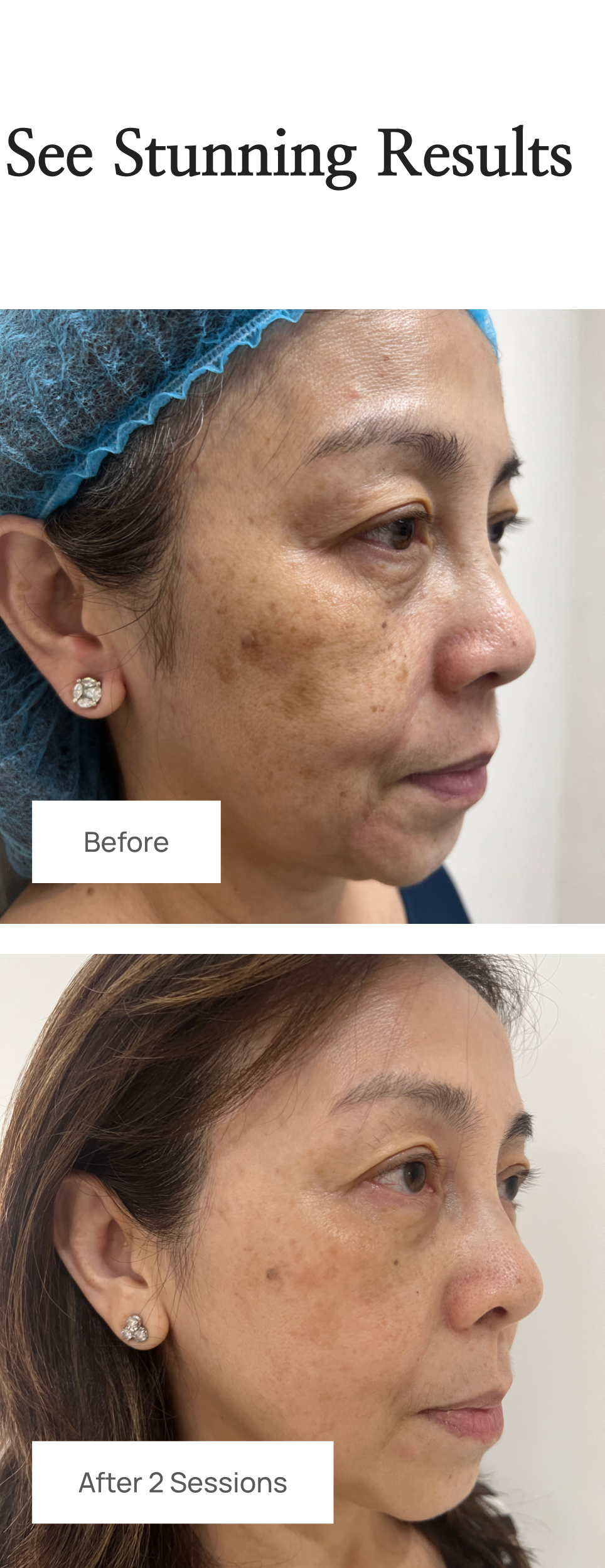 PicoSure Pro Laser – Wunderskin PH