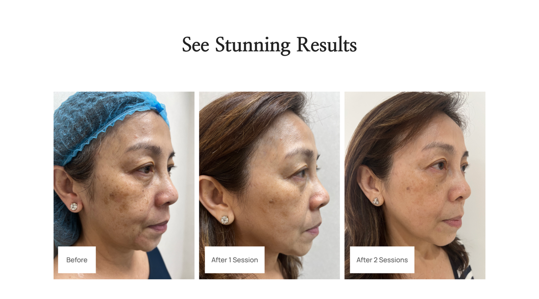 PicoSure Pro Laser – Wunderskin PH