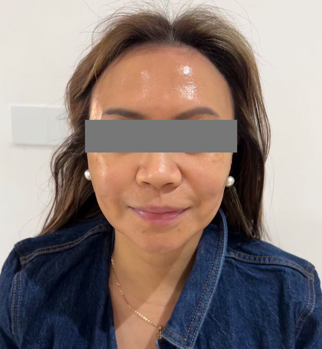 Ultra V Facial Threadlift – Wunderskin PH