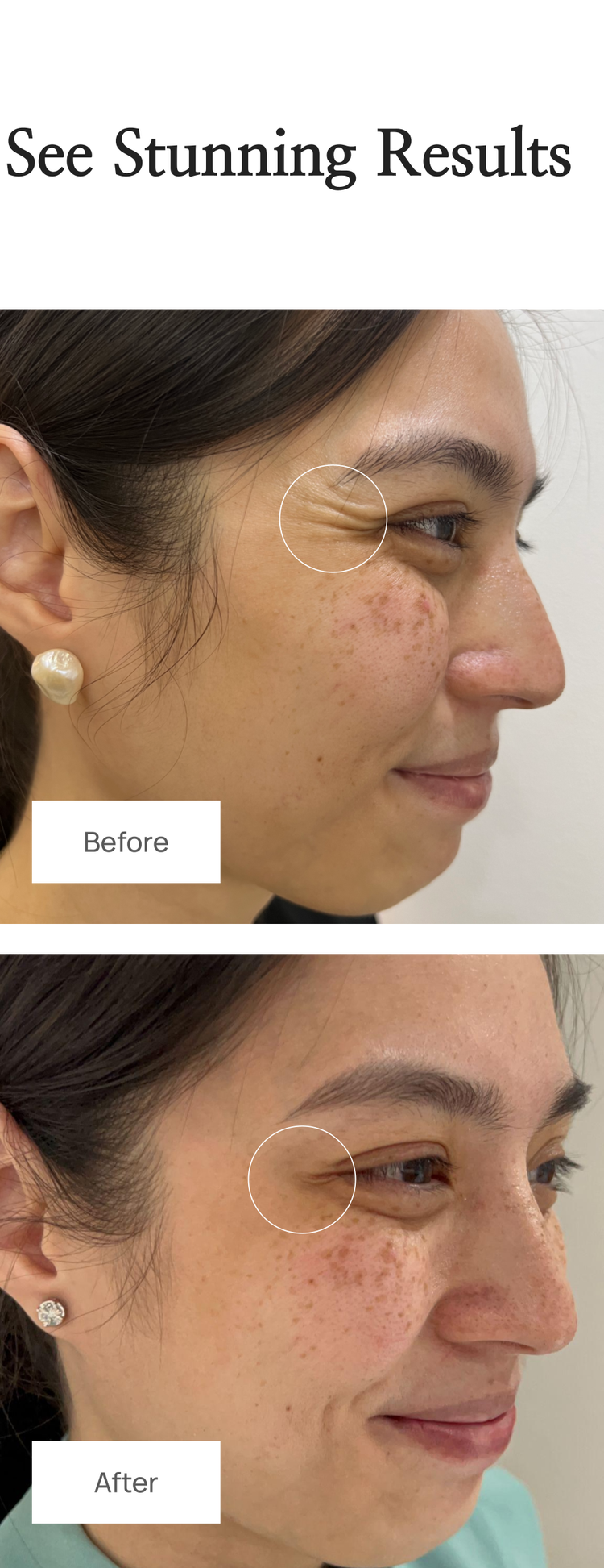 Botulinum Toxin Injections – Wunderskin PH