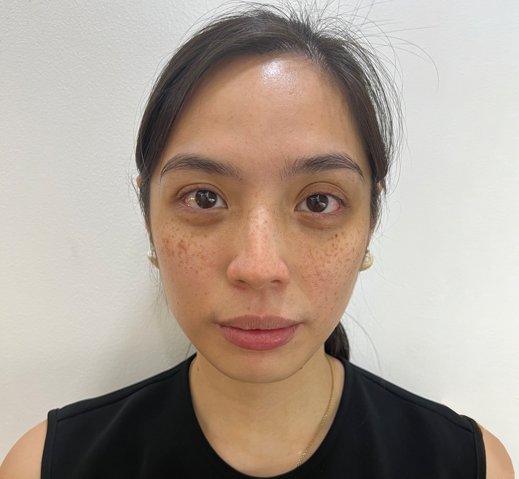 PicoSure Pro Laser – Wunderskin PH